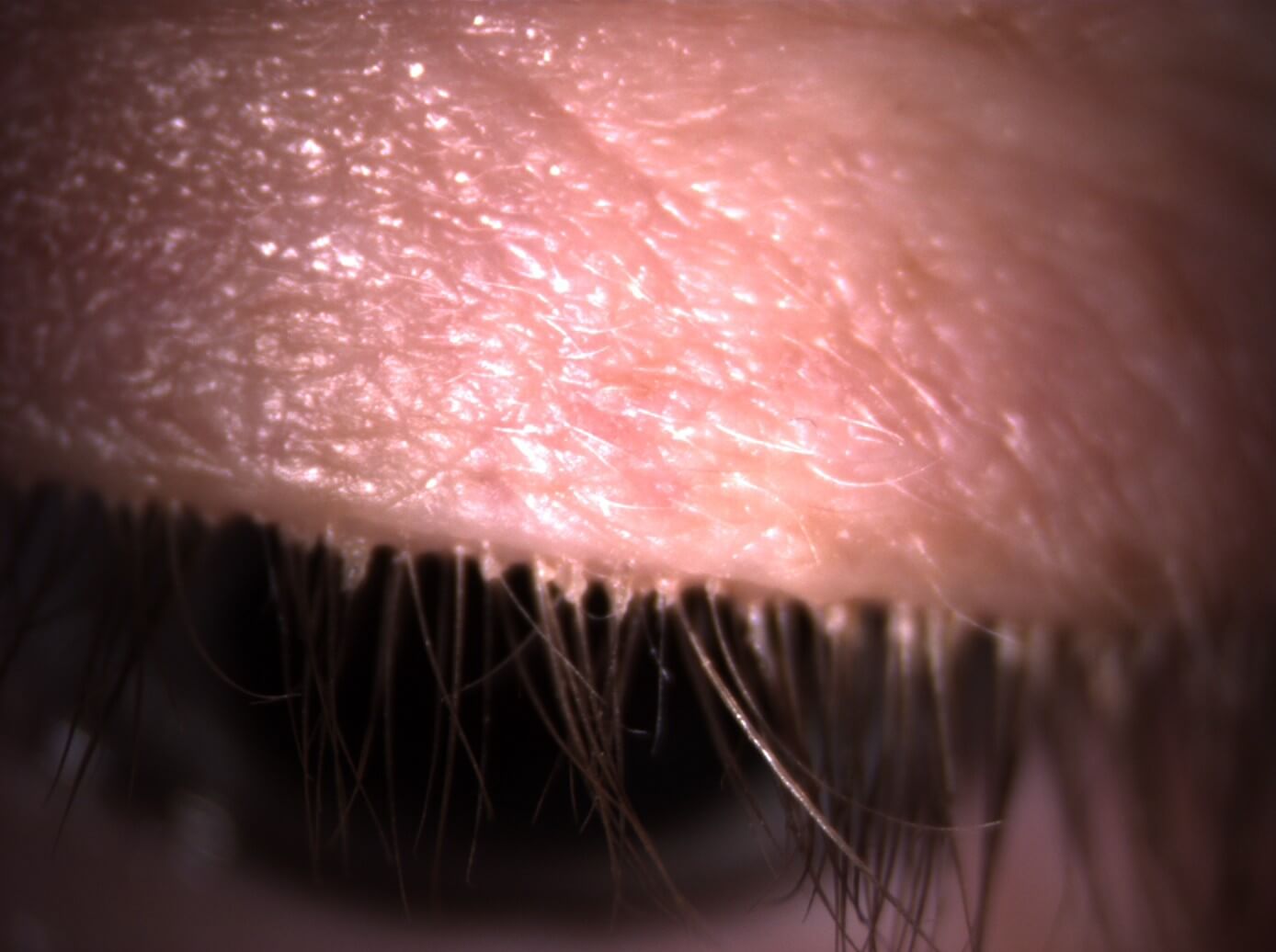 Discover Demodex | Look at the Lids